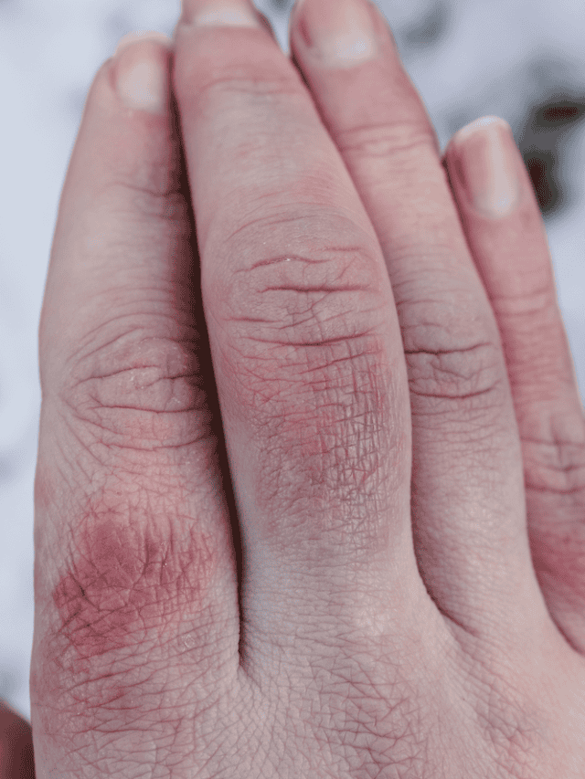 Chilblains In Winters: Know The 5 Risk Factors - Tata 1mg Capsules