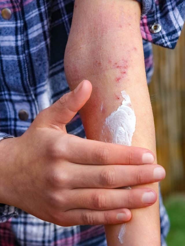 5 Signs Of Atopic Dermatitis You Shouldn’t Ignore - Tata 1mg Capsules