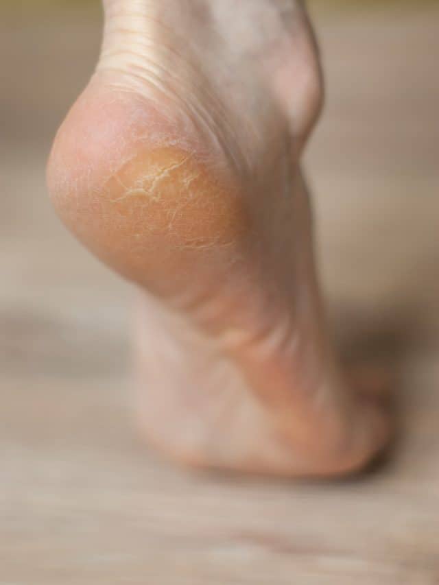Vitamin deficiency that can cause cracked heels - Tata 1mg Capsules